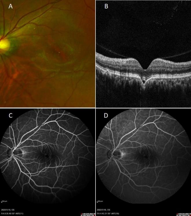 局限性脉络膜凹陷的临床研究进展