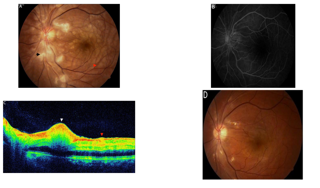 Purtscher样视网膜病变的临床观察
